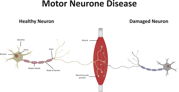 How To Live Better With Motor Neurone Disease