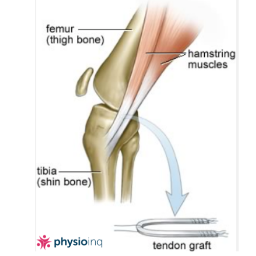 Anterior Cruciate Ligament Treatment Options | Physiotherapy Approach