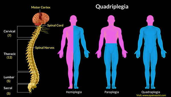 Spinal Cord Injury Quadriplegia Spinal Cord Injury Quadriplegia